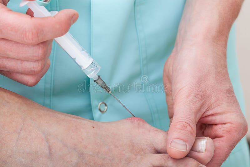 Inyección del calmante imagen de archivo. Imagen de suplemento - 32907311