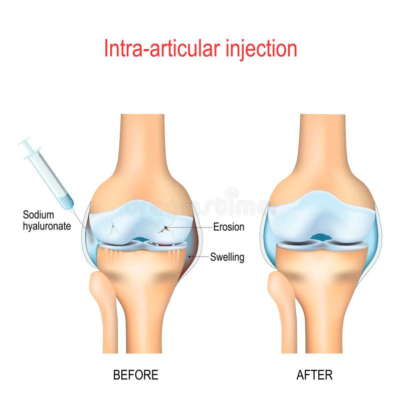 Inyección De ácido Hialurónico Para La Artrosis De Rodilla Ilustración Del Vector Ilustración