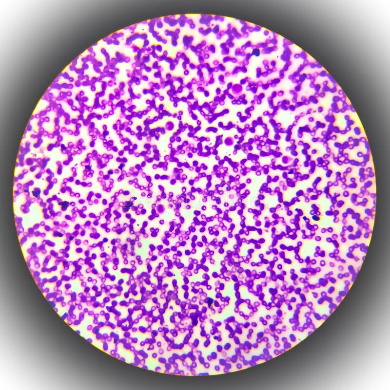 Iron Deficiency Anemia Rbc Morphology at Robert Doss blog