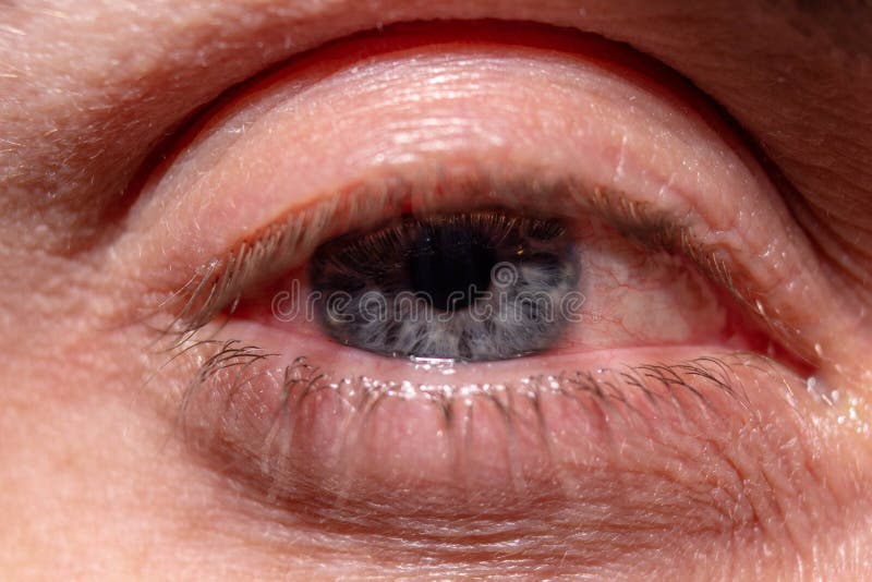 Irritated Red Eye with Capillaries during the Course of the Flu. Near ...
