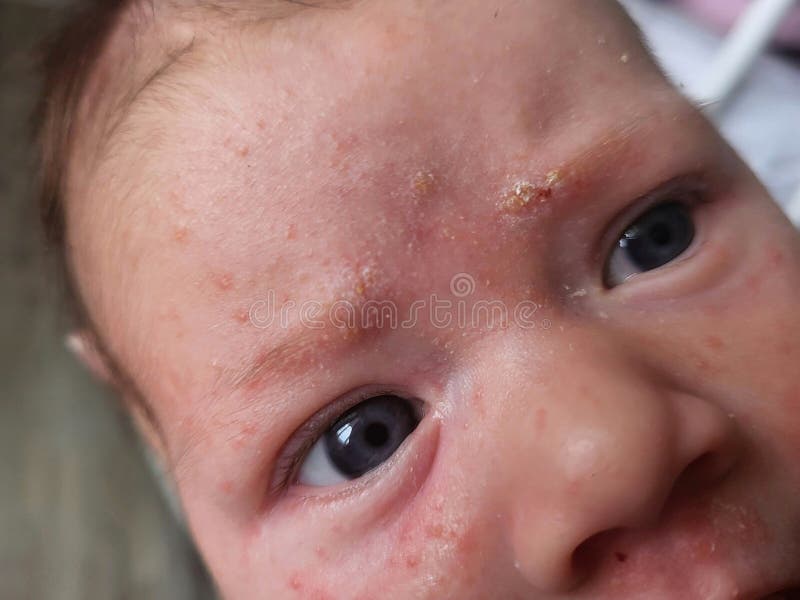 Irritation on a Child S Face Stock Image - Image of mucus, irritation ...