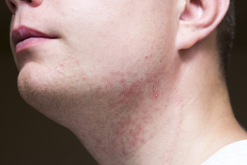 Irritation after Shaving on the Neck of a Man, Close-up Stock Image ...