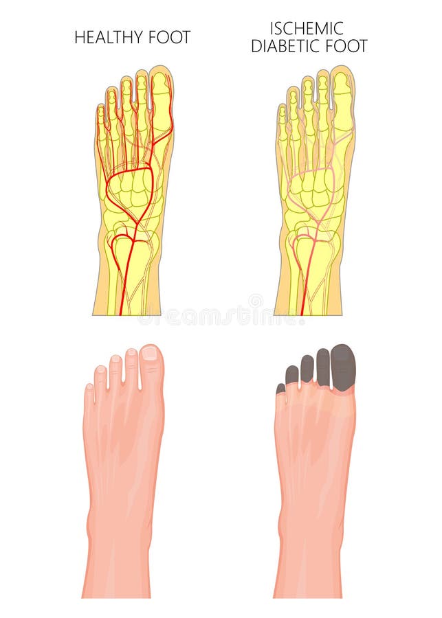 Ischemische Diabetesvoet vector illustratie. Illustration of been ...