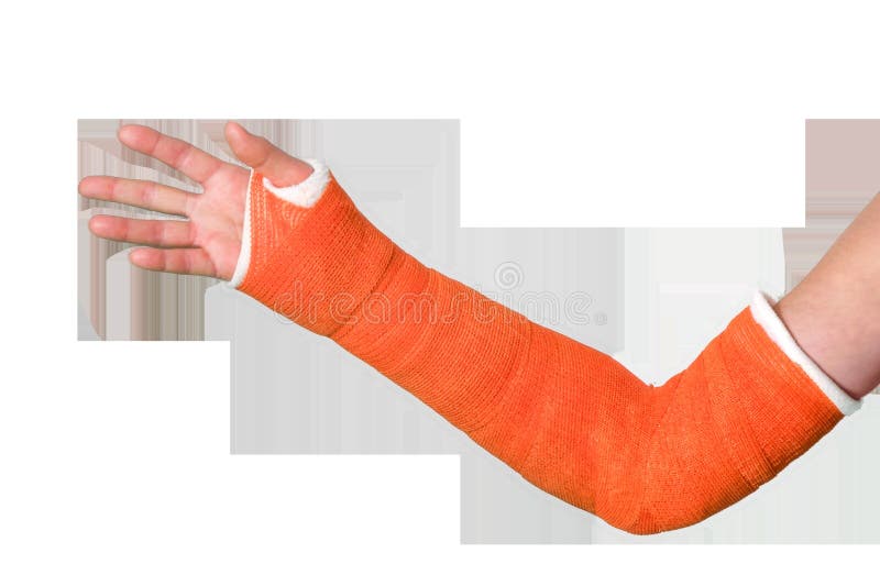 Isolated Hand in an Orange Plaster Cast after a Fracture of the Wrist ...
