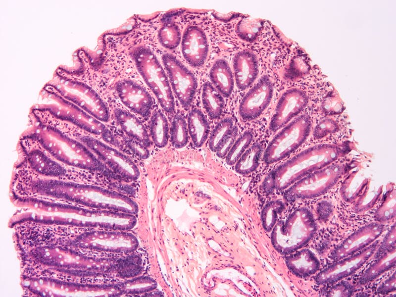 L'istologia Del Tessuto Umano, Mostra La Necrosi Corticale Del Rene ...