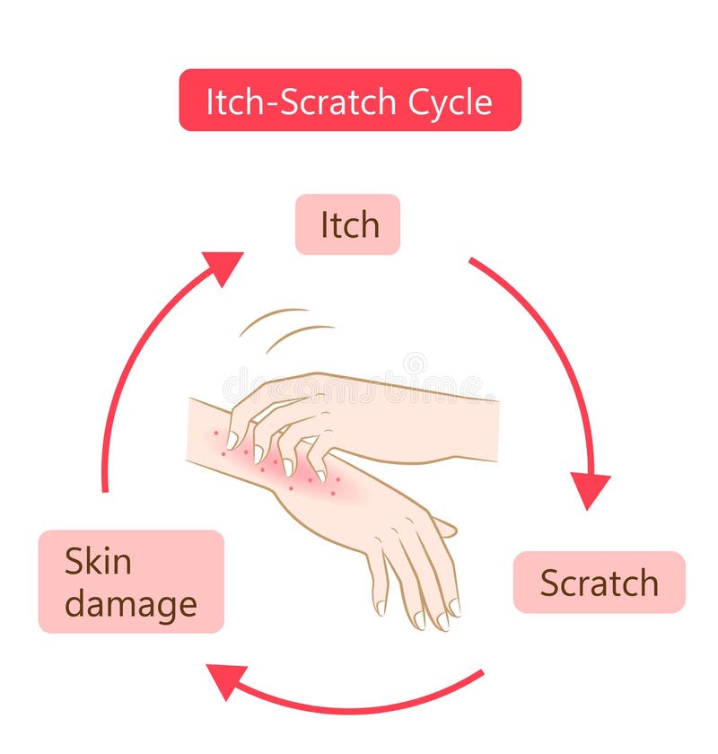 Itch Scratch Cycle Hands Illustration. Dry, Dermatitis and Atopic ...