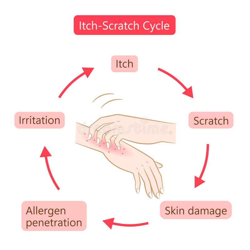 Itch Scratch Cycle Hands Illustration Dry Dermatitis And Atopic Eczema Condition Healthy Skin