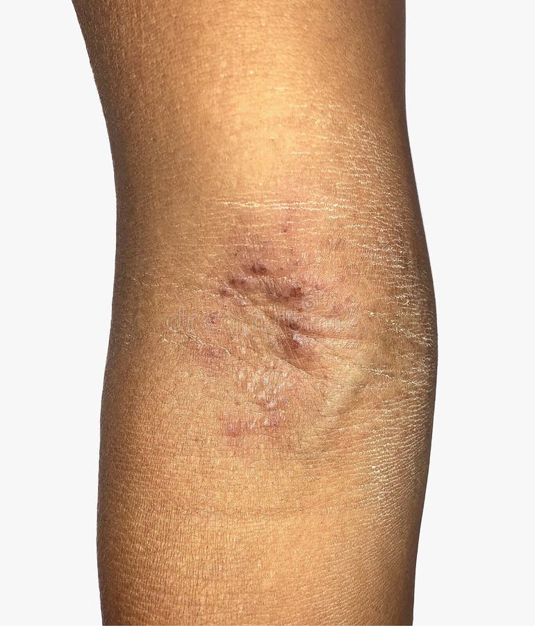 Itching Skin Lesions on Upper Limb Stock Photo - Image of infection ...
