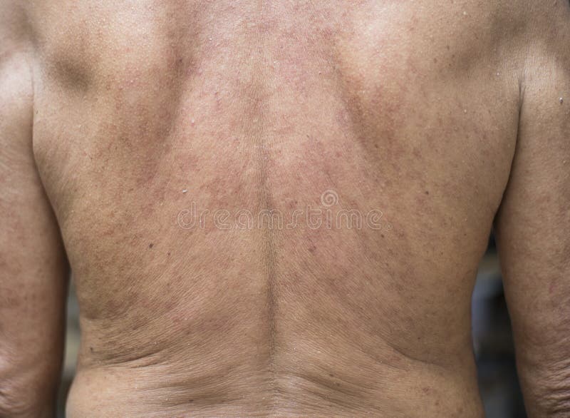 Itchy Rash, Red Bumps on Human Skin Stock Image - Image of human, adult ...