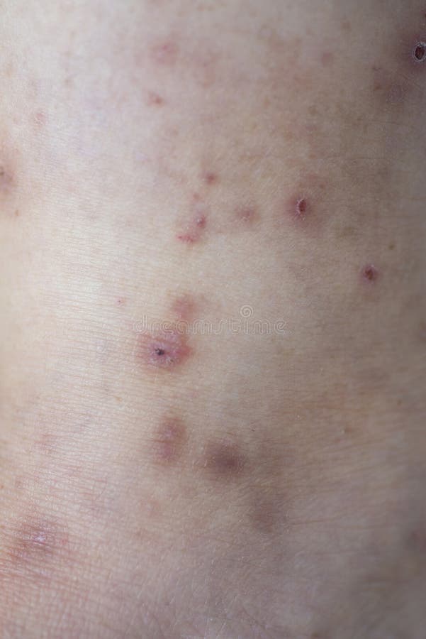 Itchy rash on the skin stock image. Image of ailing - 328966457