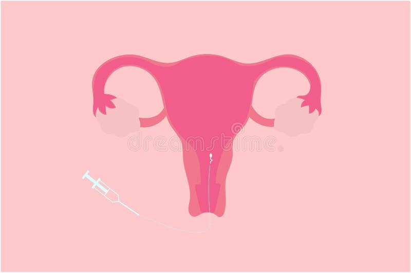 IUI Intrauterine Insemination Vector Illustration Stock Vector ...
