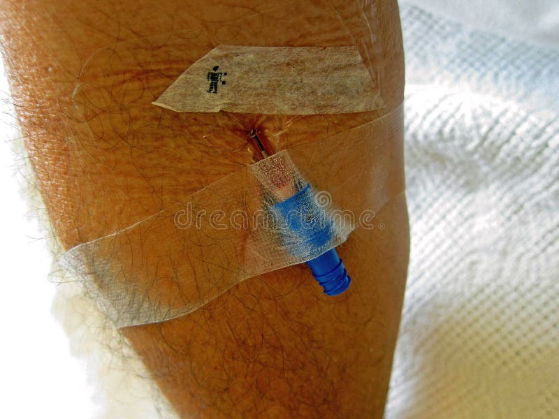 IV Needle in Arm male hair stock image. Image of intravenous - 144750485