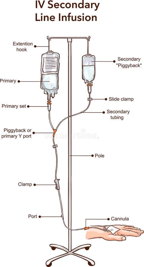 IV Secondary Line Infusion Vector Illustration Stock Vector ...