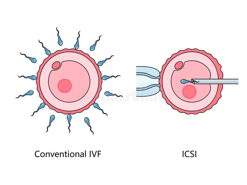 IVF and ICSI Fertilization Techniques Comparisone Stock Vector ...