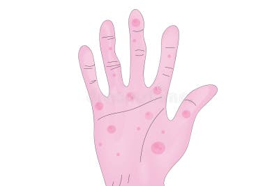 Janeway Lesions Stock Illustrations – 2 Janeway Lesions Stock ...