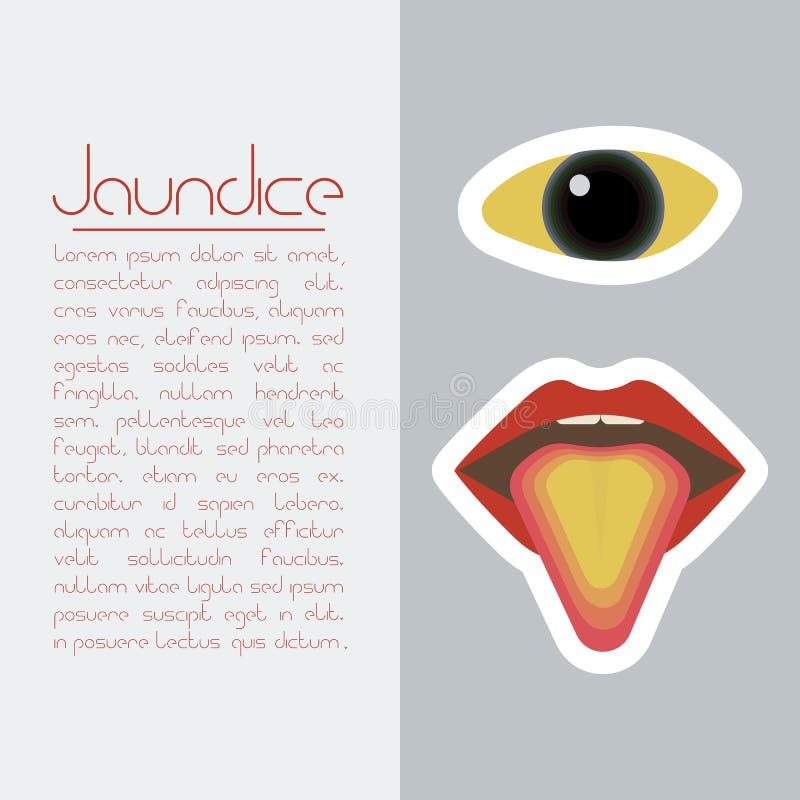 Jaundice Concept. Vector Illustration Stock Vector - Illustration of ...