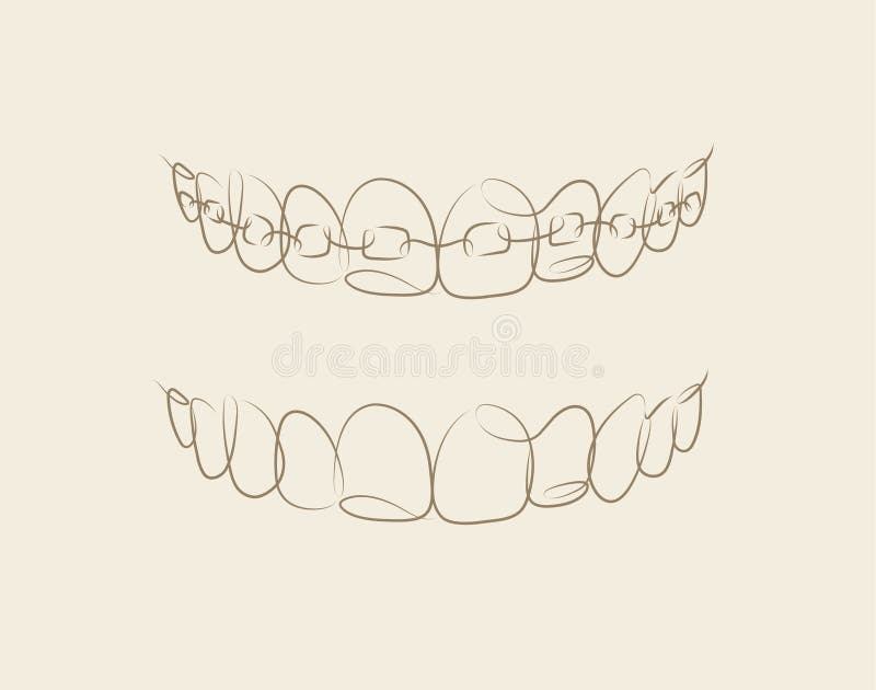 Jaws with and without Braces Installed Beige Color Stock Vector ...