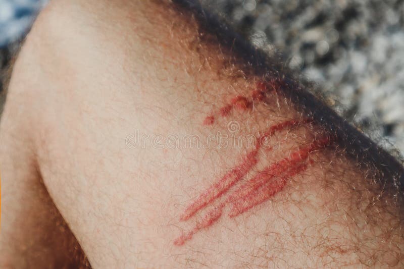 A Jellyfish Sting Burn on a Man S Leg Stock Image - Image of care ...