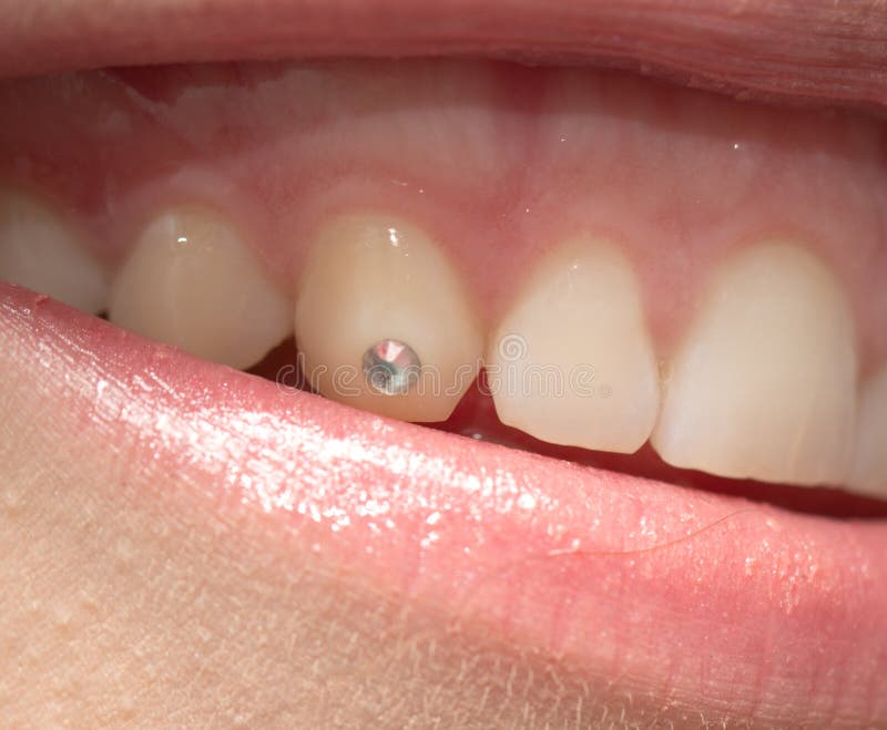 Jewel in the tooth stock photo. Image of closeup, equipment - 101459054
