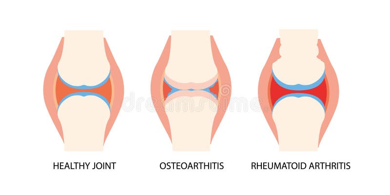 Joint Anatomy, Osteoarthritis and Rheumatoid Arthritis Infographic ...
