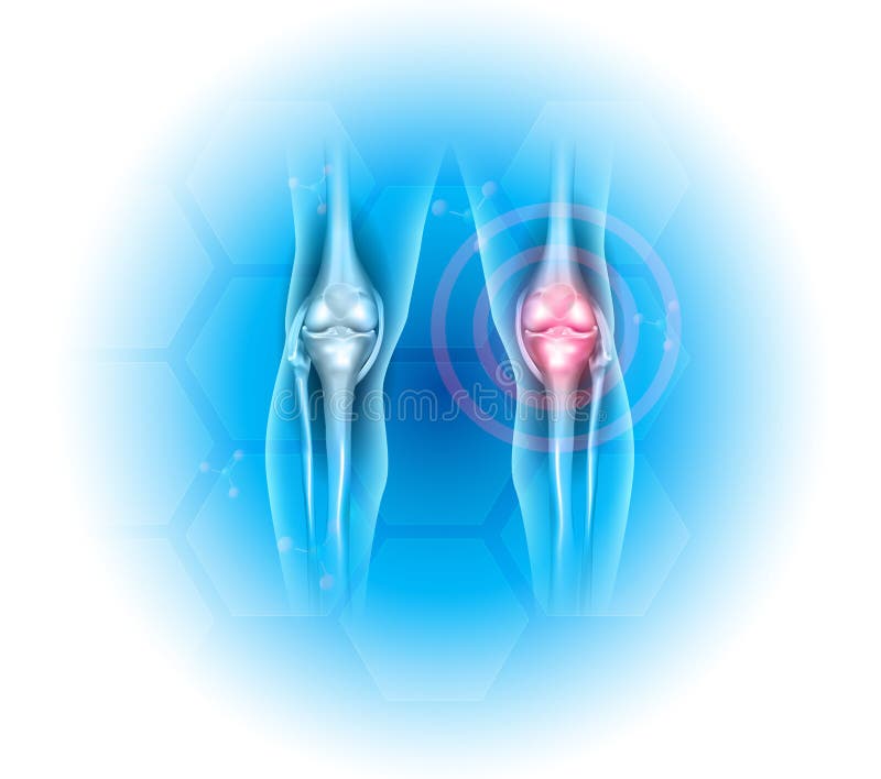 Hip joint with legs stock illustration. Illustration of joint - 46887320