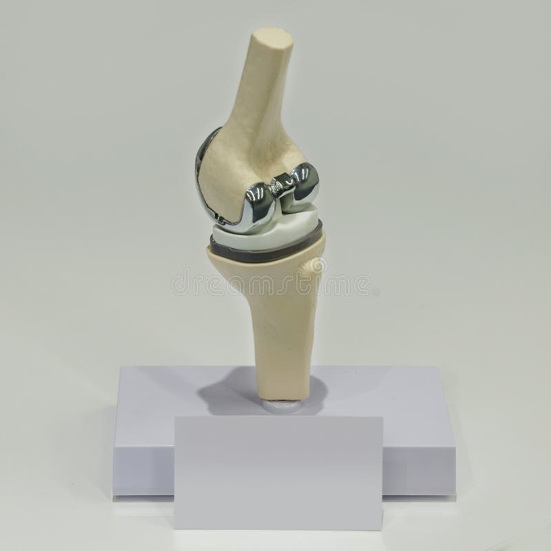 Joint prosthesis stock photo. Image of meniscus, fracture - 77326800