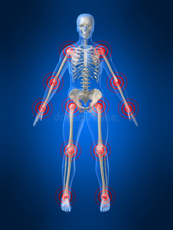 Joints inflammation stock illustration. Illustration of chest - 3257994