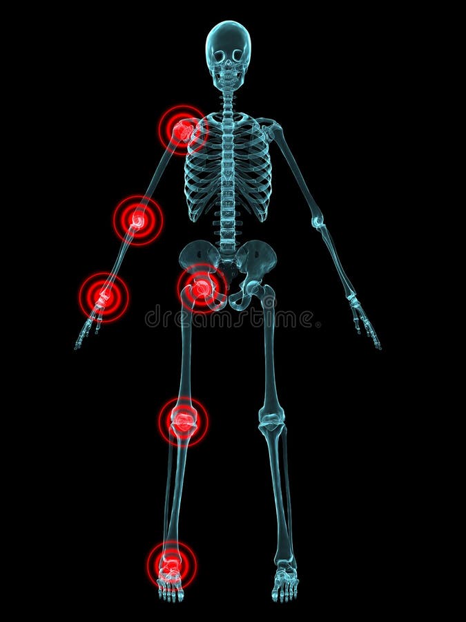 Joints inflammation stock illustration. Illustration of skeleton - 3658464