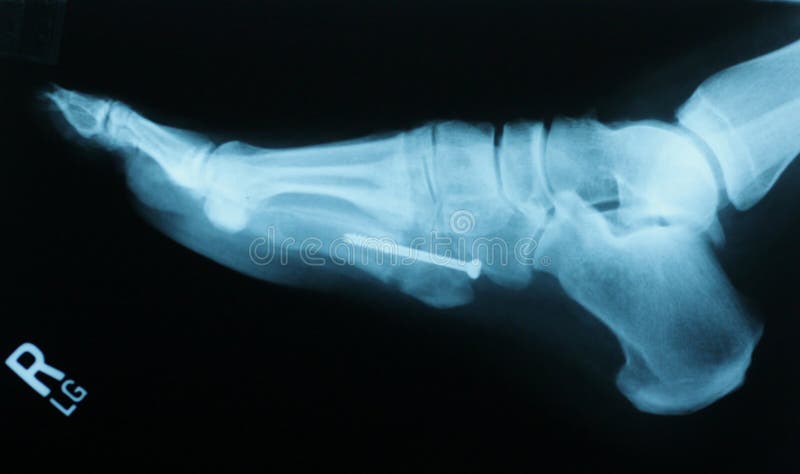 Jones Fracture Repair stock image. Image of radiograph - 18866057