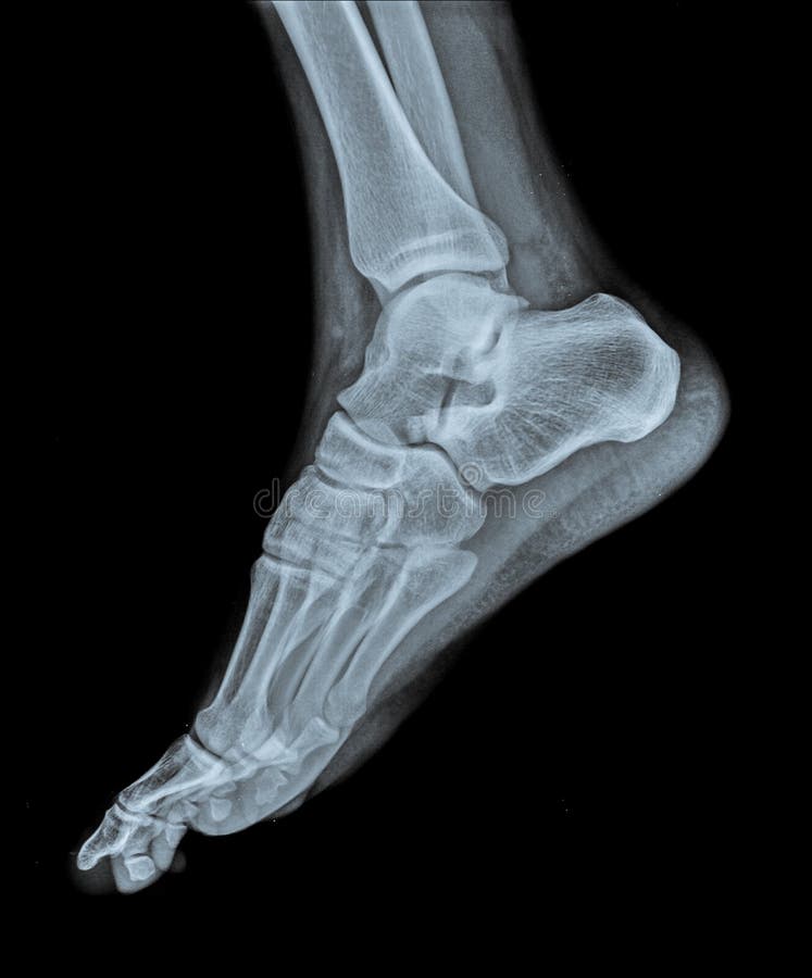 Peroné Y Tibia, Tobillo Y Pie Foto de archivo - Imagen de dedos ...