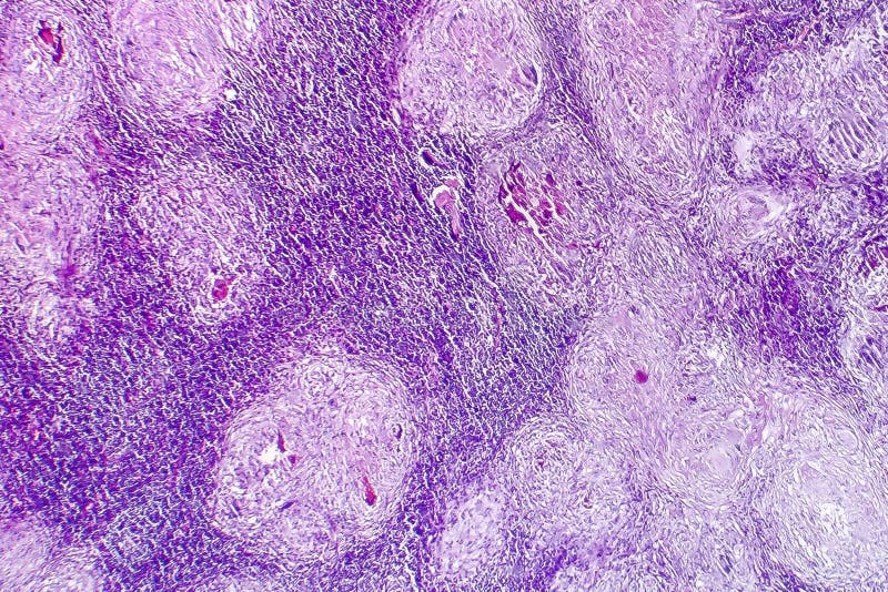 Tuberkulöse Nekrose Der Rinde Ist Eine Ziemlich Gefährliche Krankheit ...