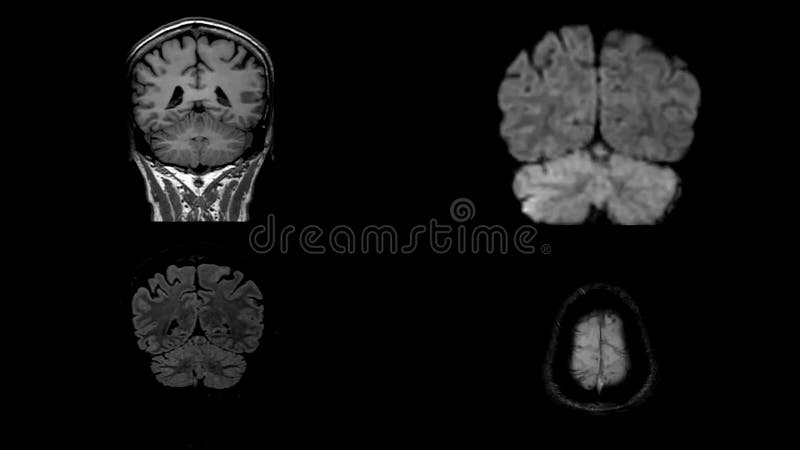 MRI of the Brain in Different Projections. Horizontal, Vertical ...