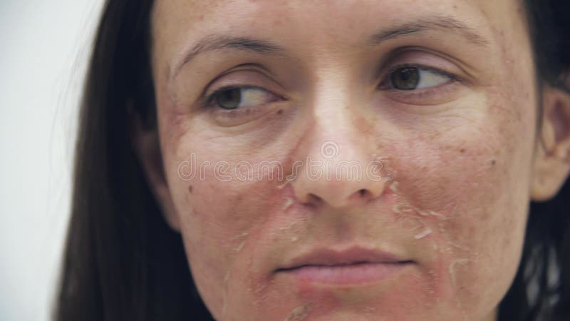 4k Video of Close Up Female Face with Skin Problems. Stock Footage ...