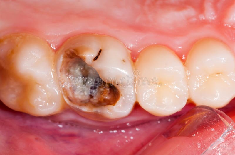 Karies stockbild. Bild von mündlich, bakteriell, gesundheit - 33300745