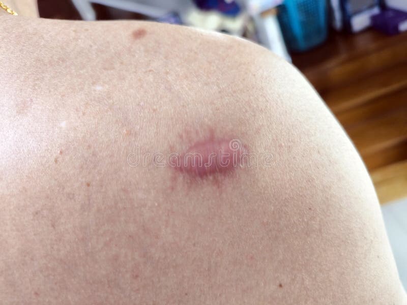 Keloid Scar on the Her Shoulder of a Man Stock Image - Image of skin ...