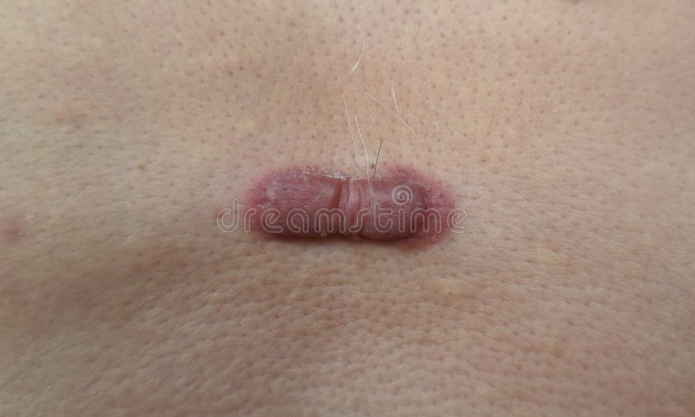Keloid Scars are Large, Raised Scars Stock Image - Image of painful ...