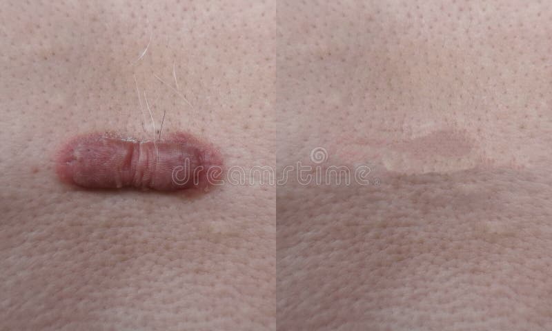 Keloid Scars before and after Treatment Stock Image - Image of body ...