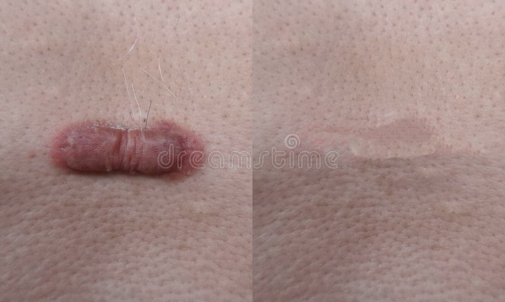 Keloid Scars before and after Treatment Stock Image - Image of body ...