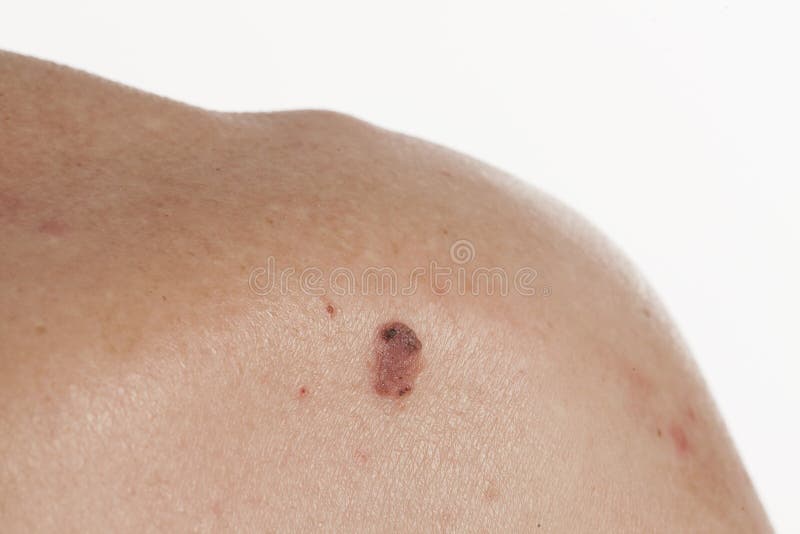 Keratinizing Squamous Cell Carcinoma of the Skin Stock Photo - Image of ...