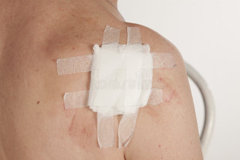 Keratinizing Squamous Cell Carcinoma of the Skin Stock Image - Image of ...