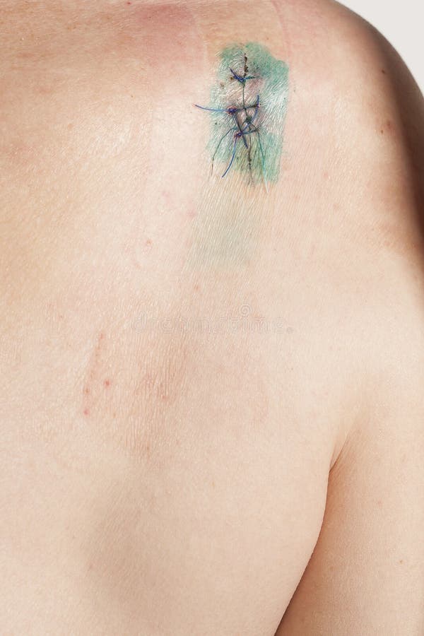 Keratinizing Squamous Cell Carcinoma of the Skin Stock Image - Image of ...