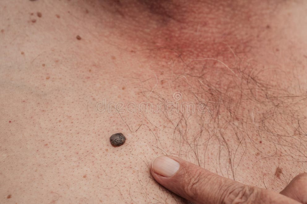 Keratinizing Squamous Cell Carcinoma of the Skin of an Elderly Man ...