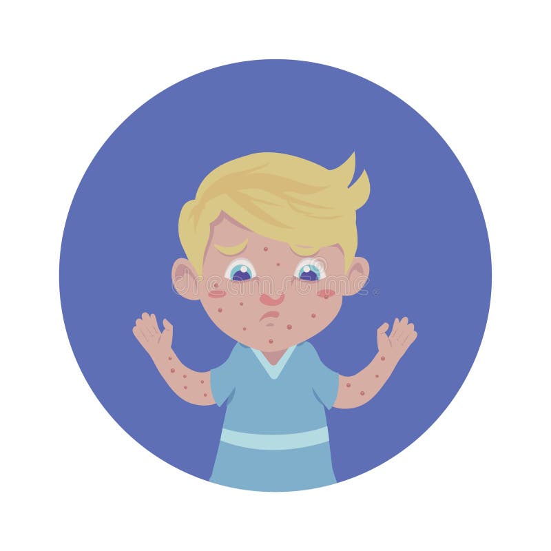 Chickenpox Stock Illustrations – 735 Chickenpox Stock Illustrations ...
