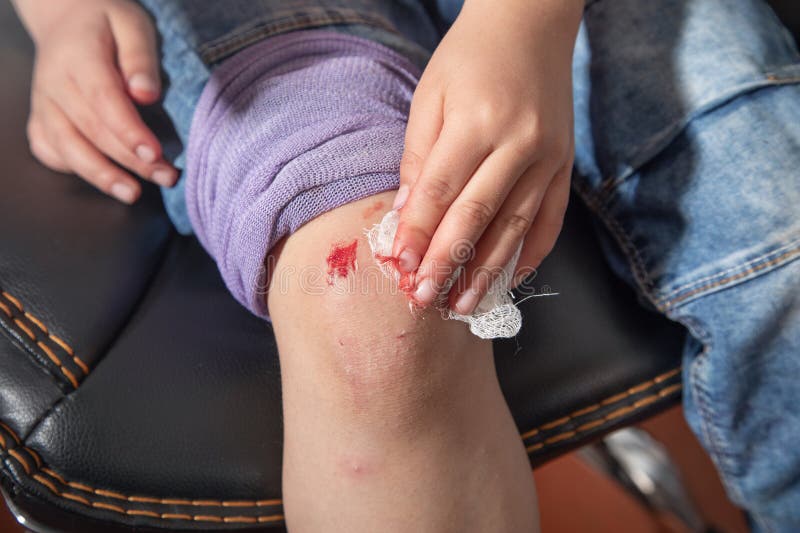 Kid with Injured Knee and Wound Stock Photo - Image of care, patient ...