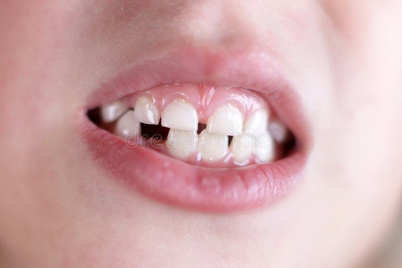 Kid with Missing Front Baby Tooth Stock Photo - Image of hole, happy ...