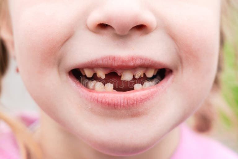 Kid Shows Off First Missing Tooth. Children without One Tooth Smiles ...