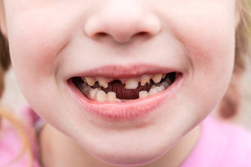 Kid Shows Off First Missing Tooth. Children without One Tooth Smiles ...