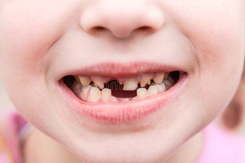 Kid Shows Off First Missing Tooth. Children without One Tooth Smiles ...