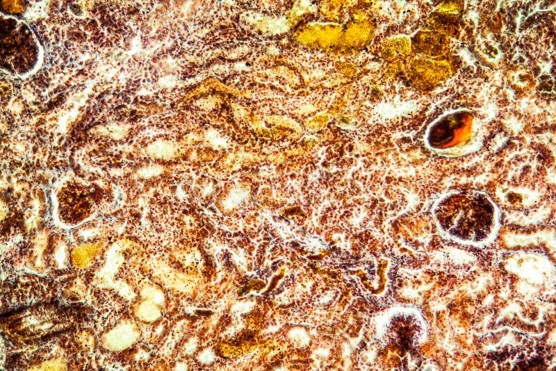 Kidney Bleeding Diseased Tissue Stock Photo - Image of glass, research ...