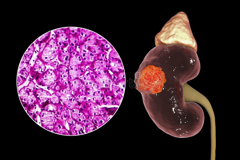 Kidney Cancer, Illustration and Light Micrograph Stock Illustration ...